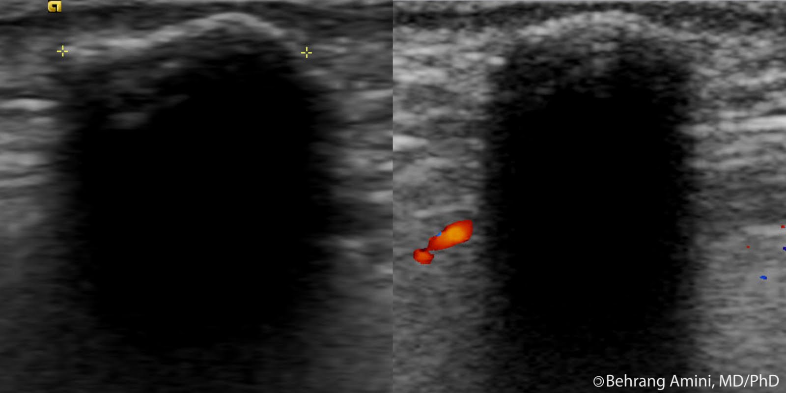 Pilomatricoma Ultrasound